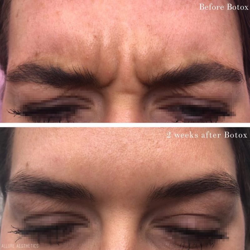 Antiageing Botox | AS Allure Aesthetics, Gloucester Rd / South ...