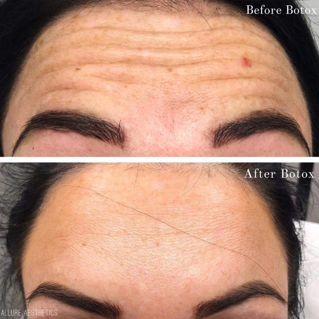 Antiageing Botox | AS Allure Aesthetics, Gloucester Rd / South ...