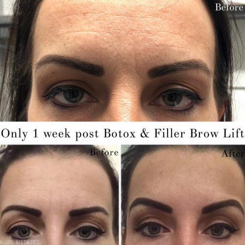 Antiageing Botox | AS Allure Aesthetics, Gloucester Rd / South ...