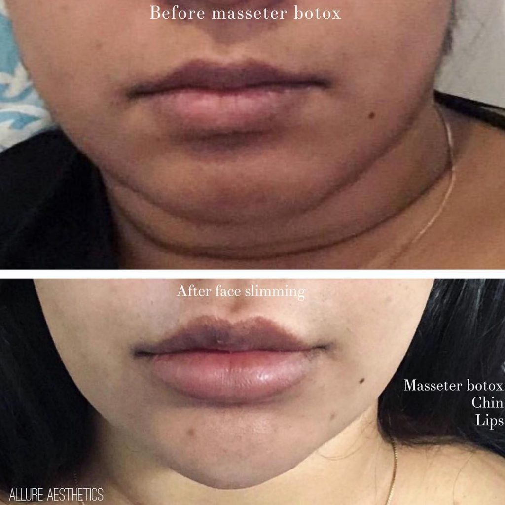 Jawline Slimming / Masseter Botox | AS Allure Aesthetics, Gloucester Rd ...