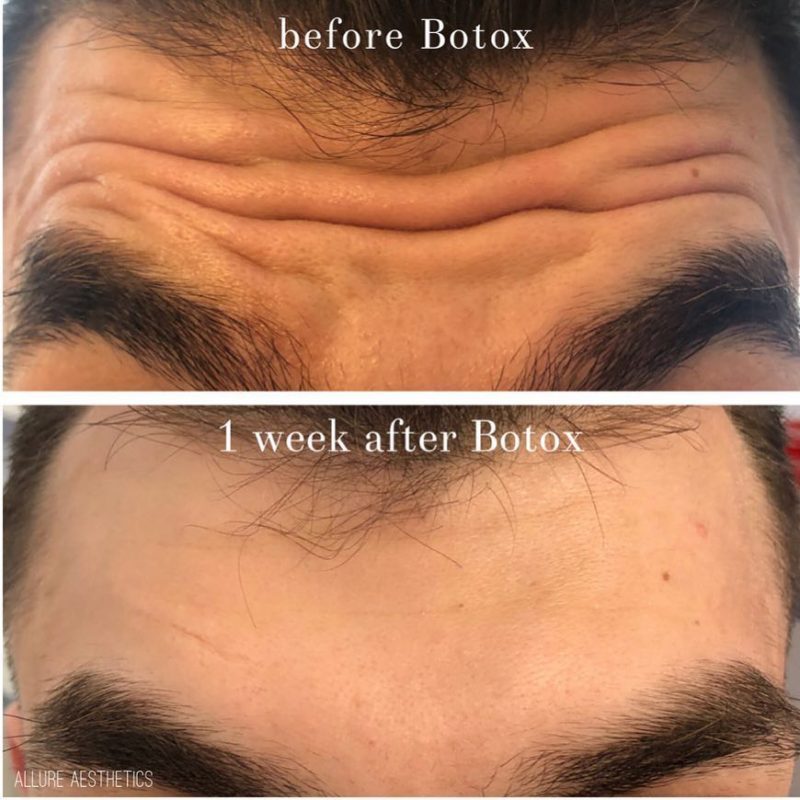 Antiageing Botox | AS Allure Aesthetics, Gloucester Rd / South ...