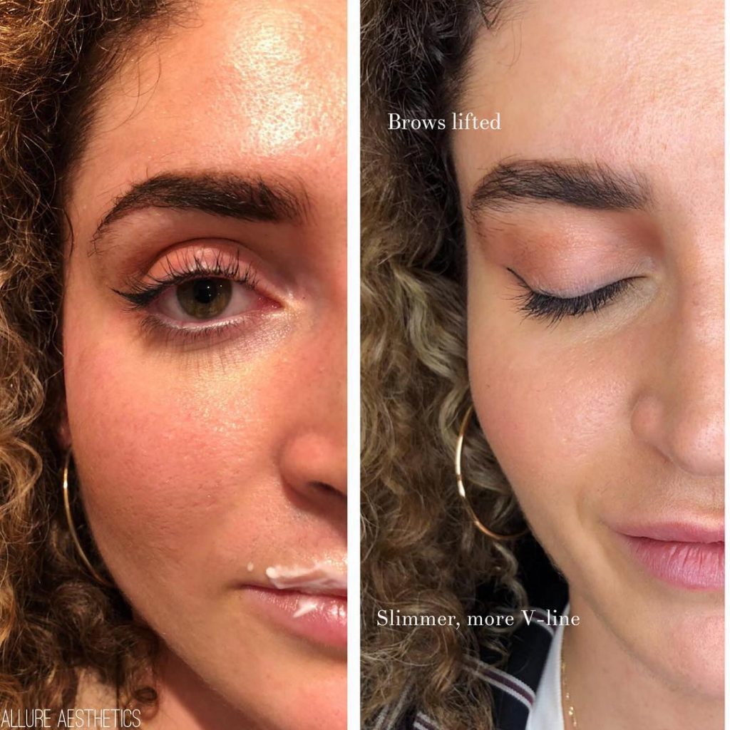 Jawline Slimming / Masseter Botox | AS Allure Aesthetics, Gloucester Rd ...