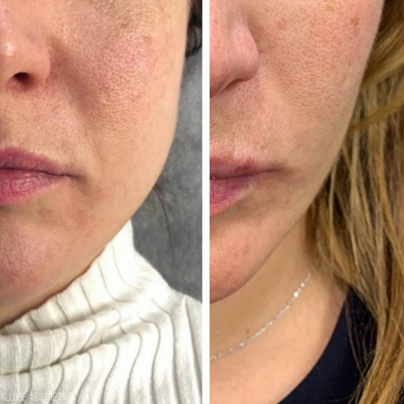 Jawline Slimming / Masseter Botox | AS Allure Aesthetics, Gloucester Rd ...
