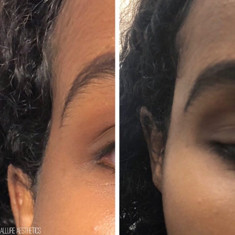 Temple / Brow Lift Fillers | AS Allure Aesthetics, Gloucester Rd ...