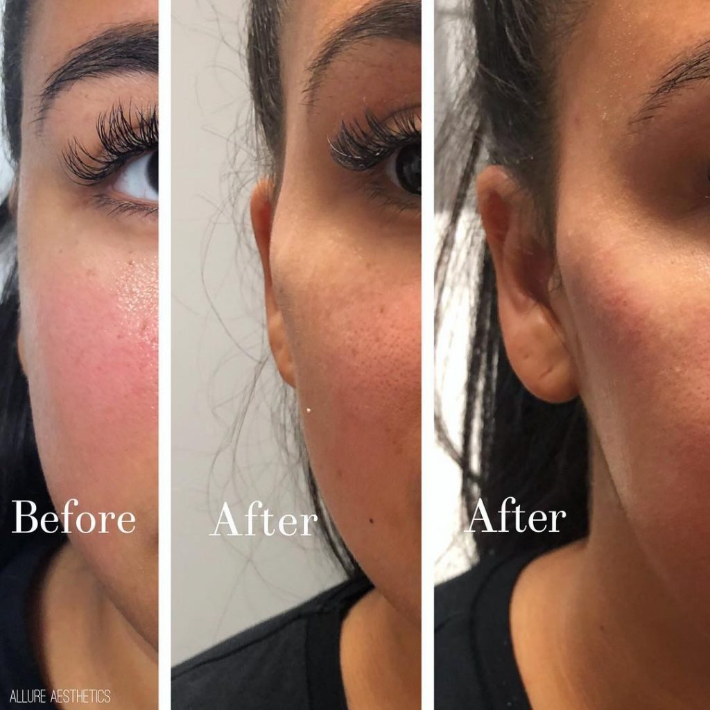 Cheek Fillers | AS Allure Aesthetics, Notting Hill / Kensington, London