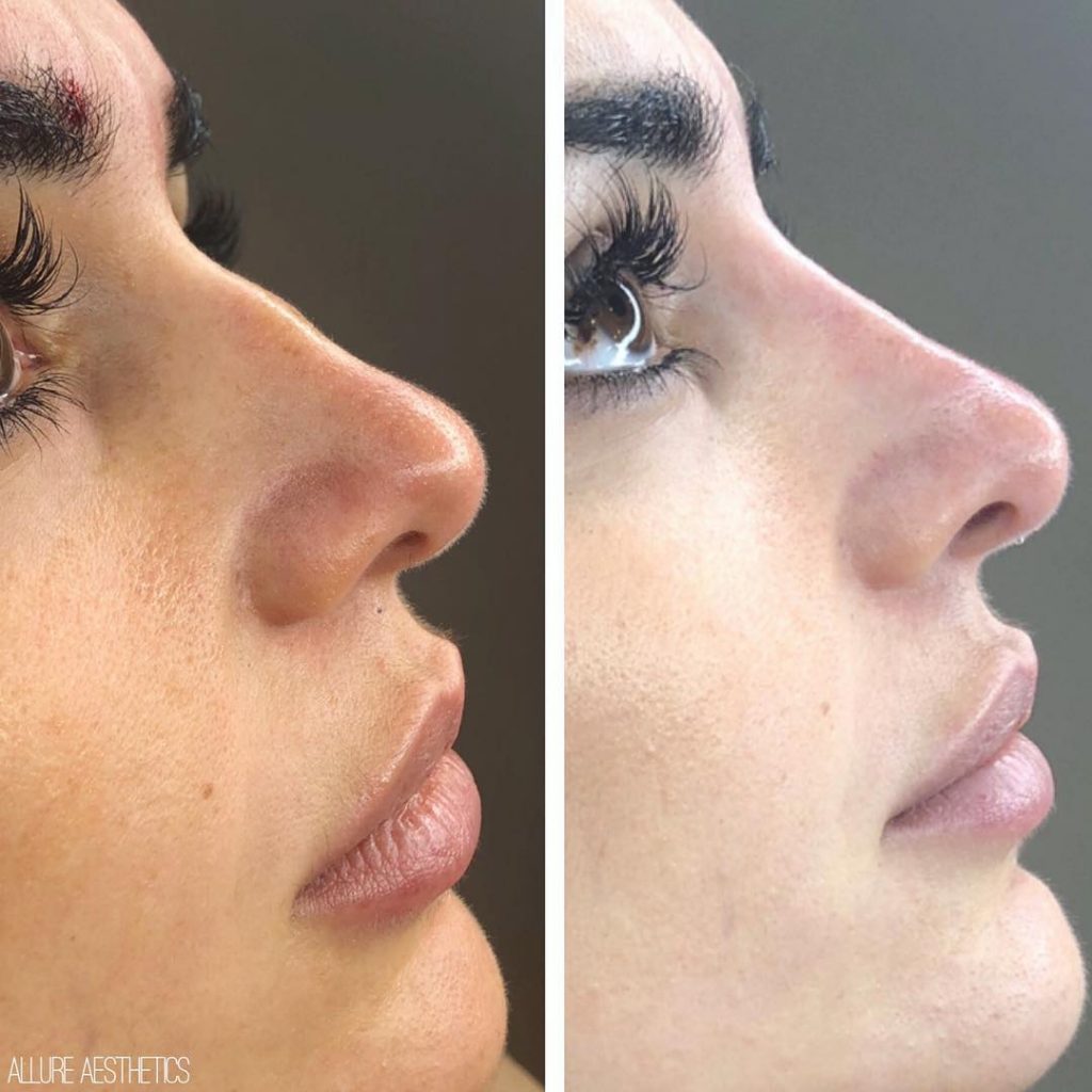 Nose Fillers | AS Allure Aesthetics, Notting Hill / Kensington, London