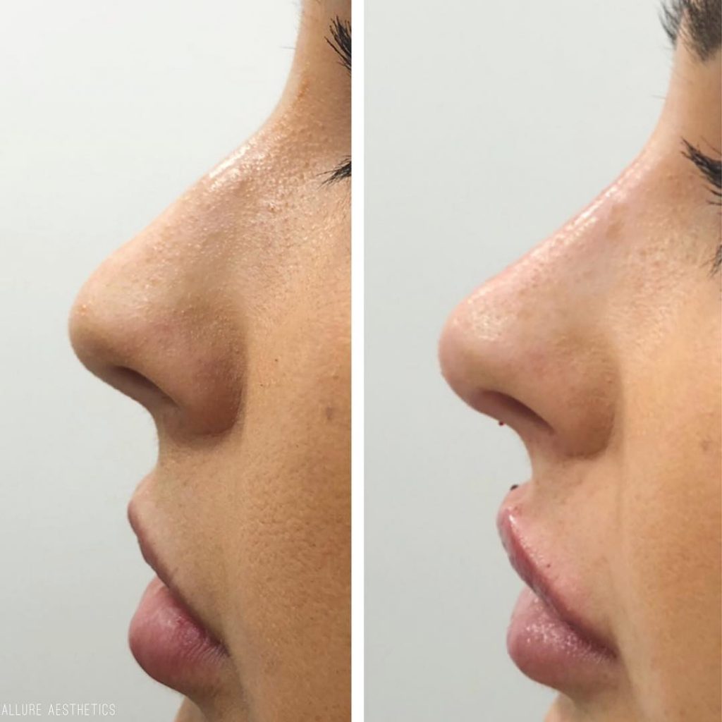 Nose Fillers | AS Allure Aesthetics, Notting Hill / Kensington, London