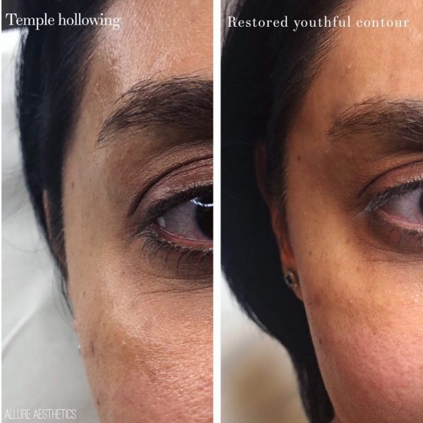 Temple / Brow Lift Fillers | AS Allure Aesthetics, Gloucester Rd ...