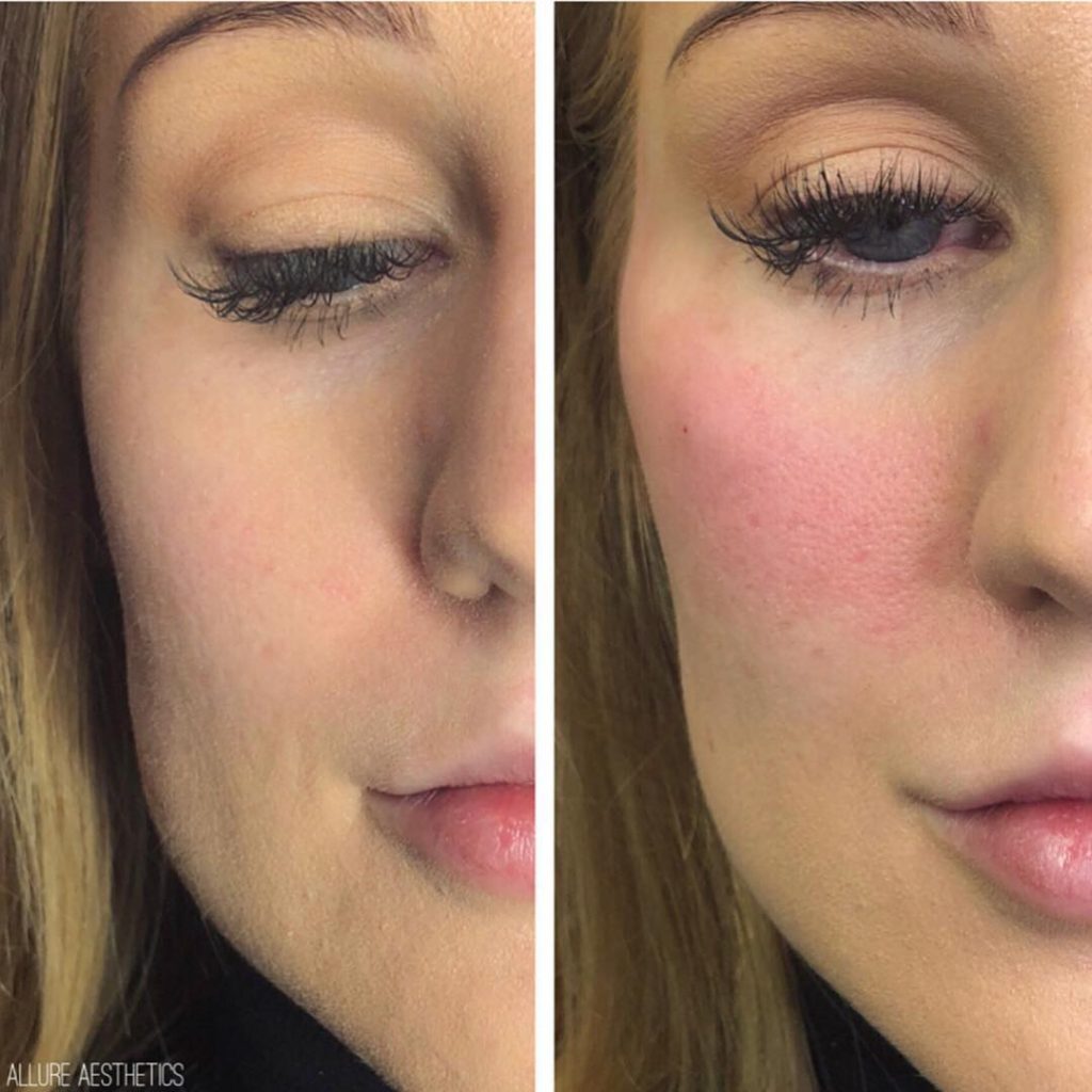 Cheek Fillers | AS Allure Aesthetics, Gloucester Rd / South Kensington ...