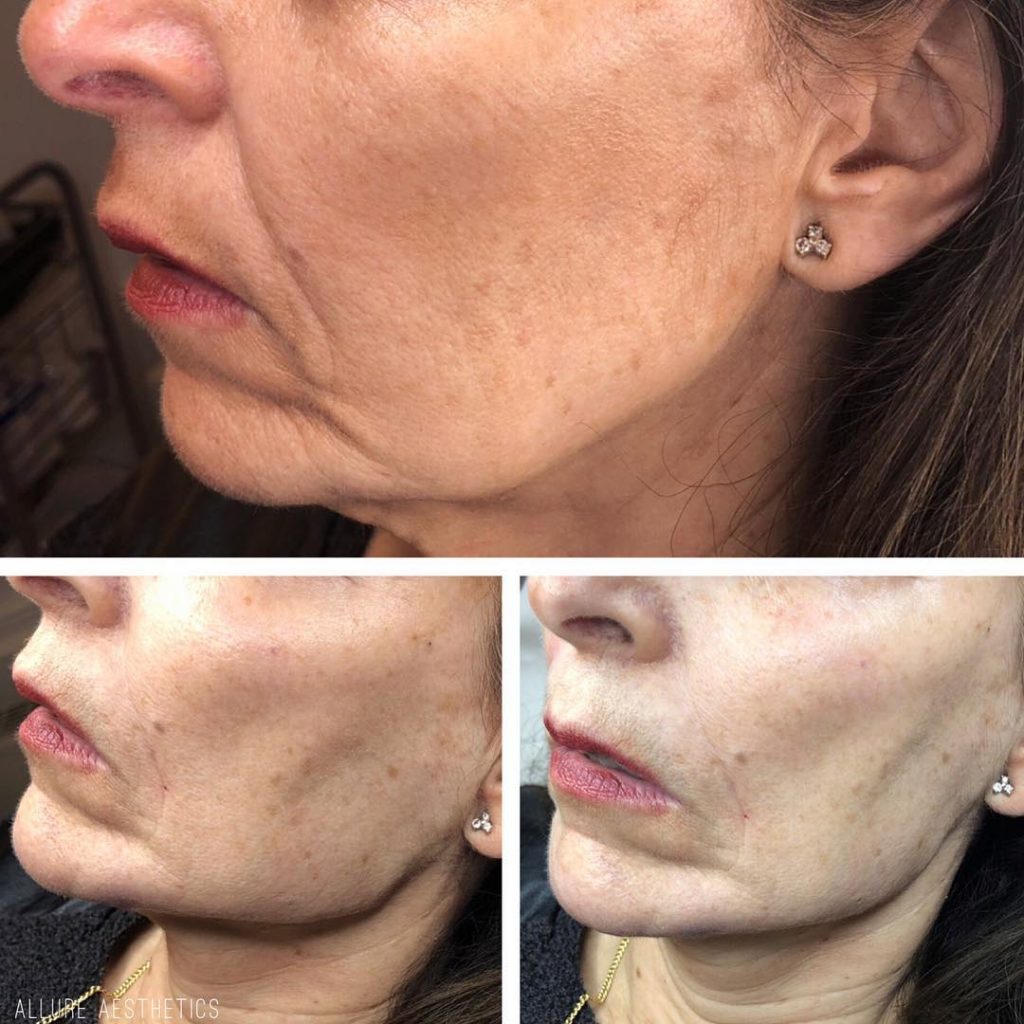 Jaw Fillers | AS Allure Aesthetics, Gloucester Rd / South Kensington ...