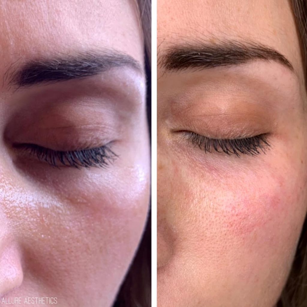 Tear Trough Fillers | AS Allure Aesthetics, Gloucester Rd / South ...